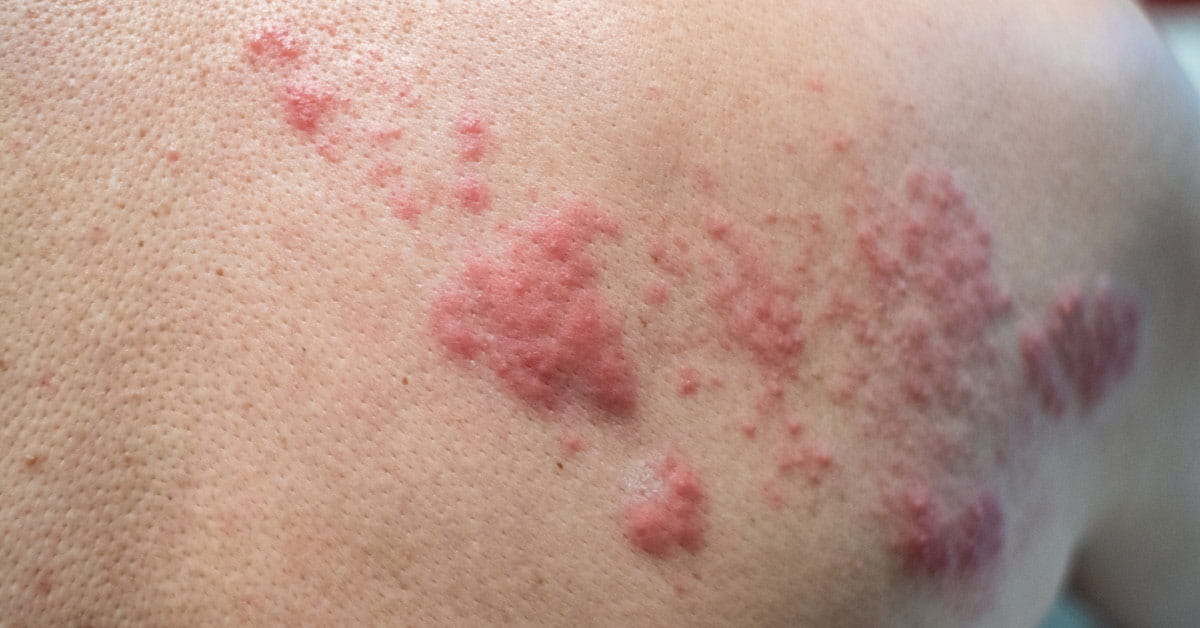 Shingles Q A Is Shingles Contagious Everything Else You Need To Know Shingles Q A Is Shingles Contagious Everything Else You Need To Know