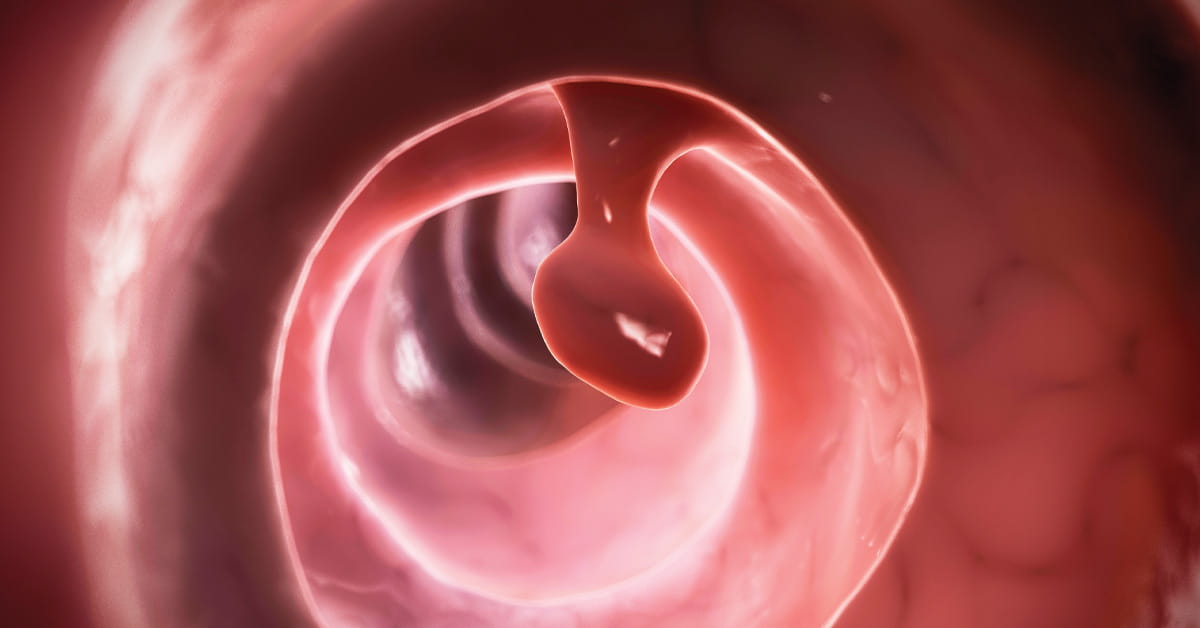 Colon Polyps & Cancer: What's the Connection?