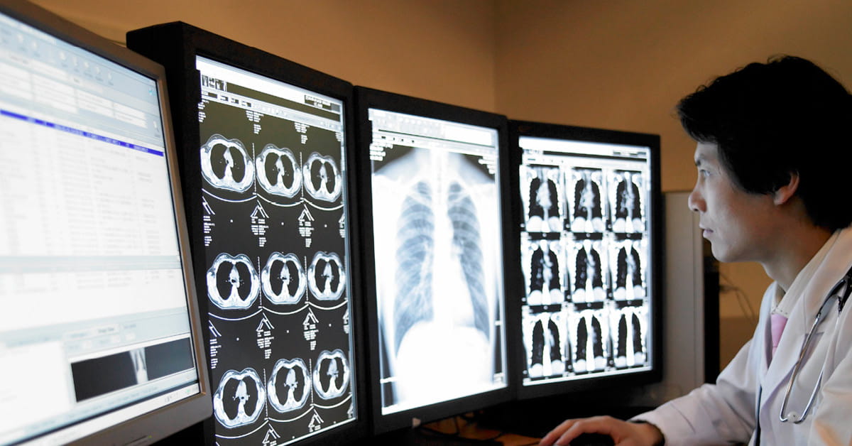 Q&A: Lung Cancer Screening | Houston Methodist On Health