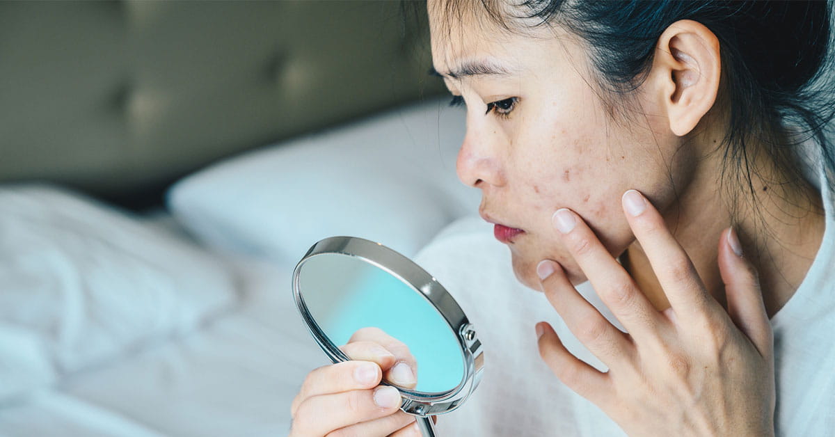 Will Acne Scars Fade Over Time? | Houston Methodist On Health