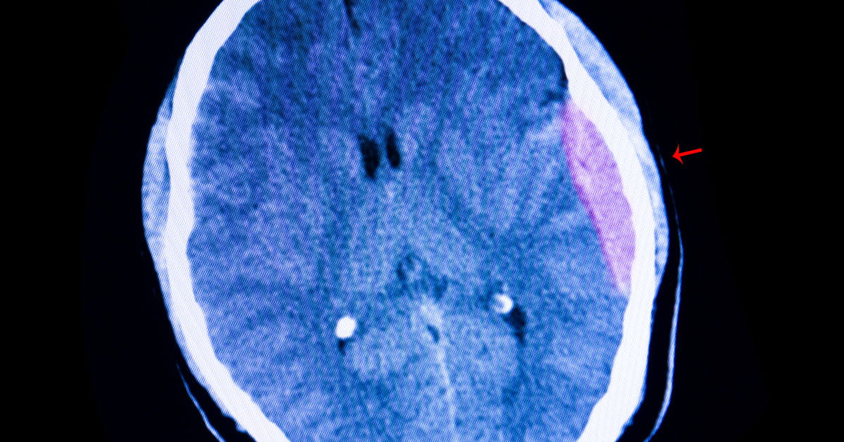 The Hidden Risks of Head Injuries | Houston Methodist On Health