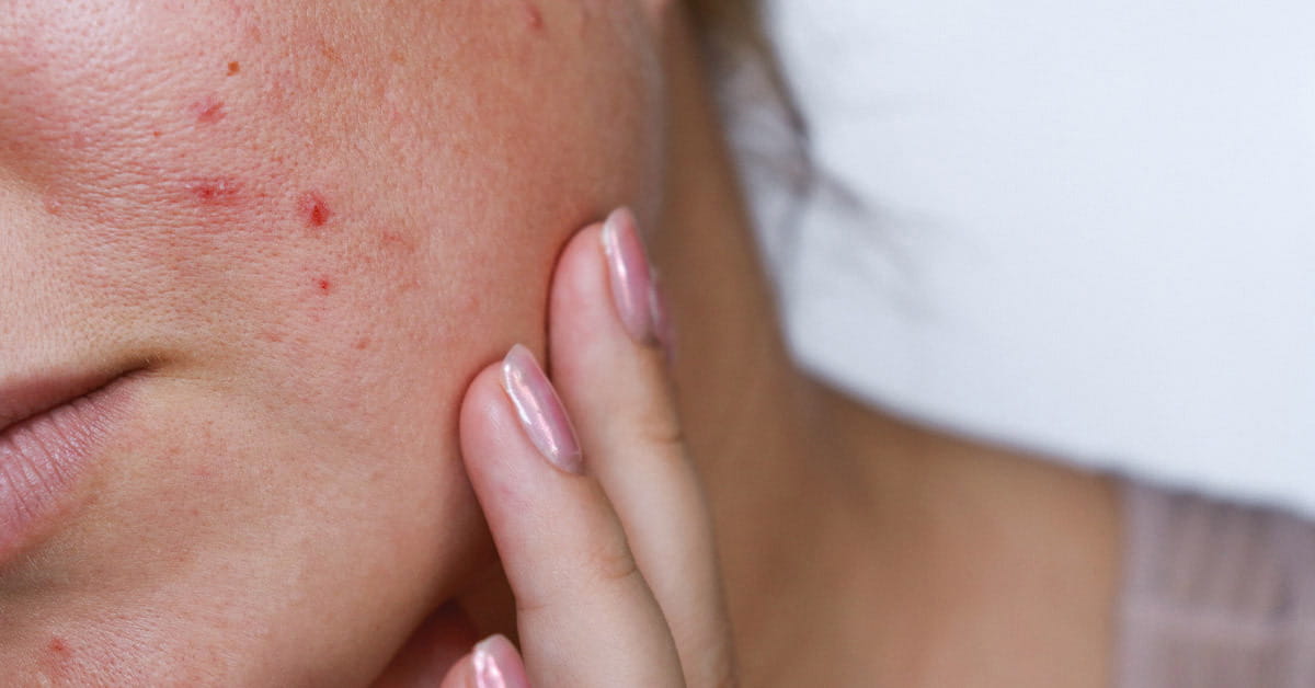Pregnancy Acne: Why It Happens & How to Get Rid of It | Houston ...