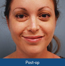 Masseter-to-facial Nerve Transfer | Houston Methodist