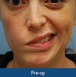 Masseter-to-facial Nerve Transfer | Houston Methodist