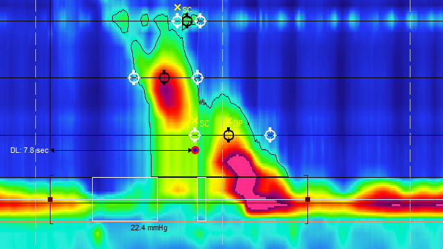 Use Endoflip and POEM for Effective Diagnosis and Treatment of Achalasia