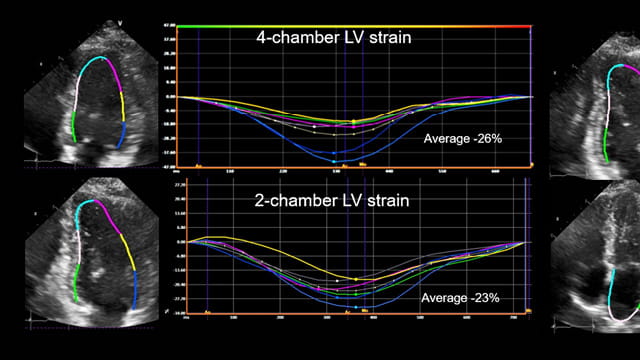 Hemodynamics Contribute to LA Strain, Exercise Tolerance and Events in ...