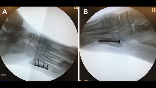 Houston Methodist Conducts a Biomechanical Comparison of Fifth ...