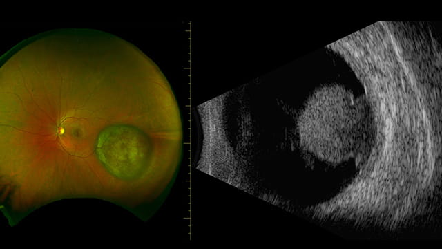 Three-Year Uveal Melanoma Study Yields Extraordinary Results | Houston ...