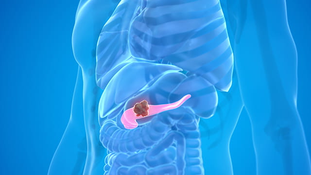Pancreatic Ductal Adenocarcinoma Study Unveils Key Molecular ...