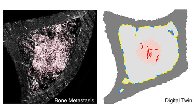 Modeling Bone Metastasis: Digital Twins Reproduce Tumor Biology with ...
