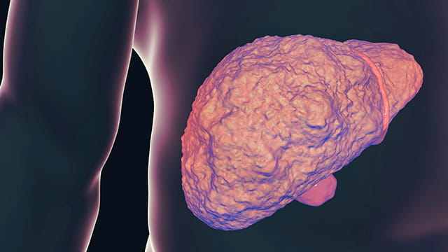 New Drug Shows First Evidence of Reversing Cirrhosis in Metabolic Liver ...