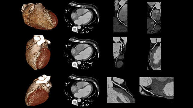 CAC Score And Atherosclerotic Cardiovascular Disease Risk Assessment Can A Test Predict The cac-score-and-atherosclerotic-cardiovascular-disease-risk-assessment-can-a-test-predict-the
