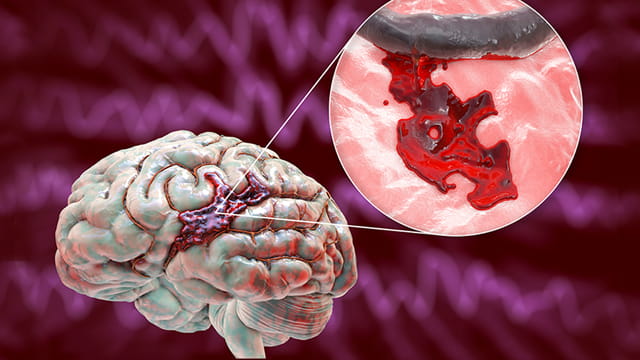 MISTIE Intracerebral Hemorrhage Intervention Shows Promise in New ...