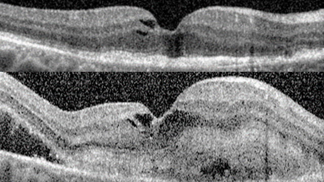 New Macular Degeneration Treatment Offers Enhanced Durability and ...