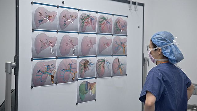 Houston Methodist Launches Leading Robotic Split Liver Transplant Program