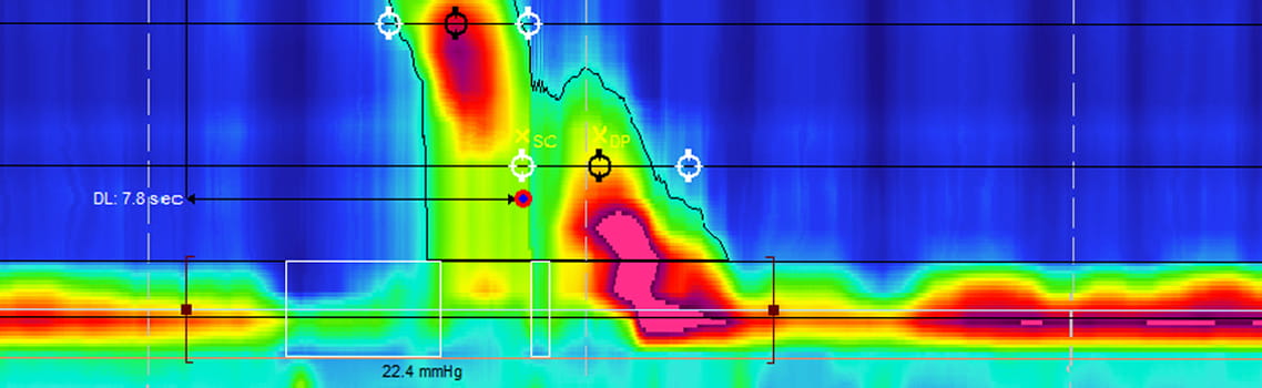 Use Endoflip and POEM for Effective Diagnosis and Treatment of Achalasia