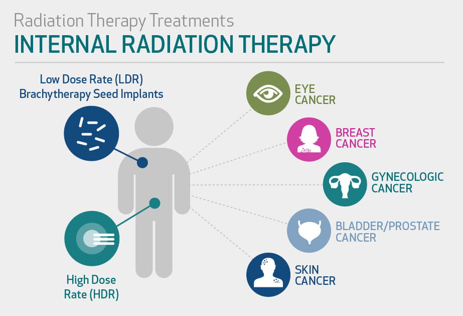 Radiation Therapy: Internal & External Radiation | Houston Methodist Radiation Therapy: Internal & External Radiation | Houston Methodist