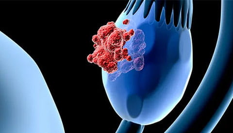 Ovarian Cancer Research & Clinical Trials | Houston Methodist