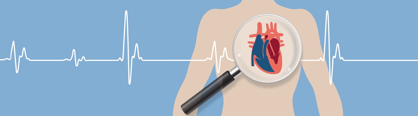 Hypertrophic Cardiomyopathy Treatment (HCM) | Houston Methodist