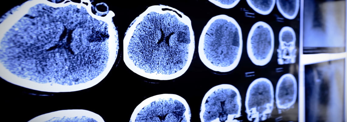 Sugar Land Stroke Center | Houston Methodist