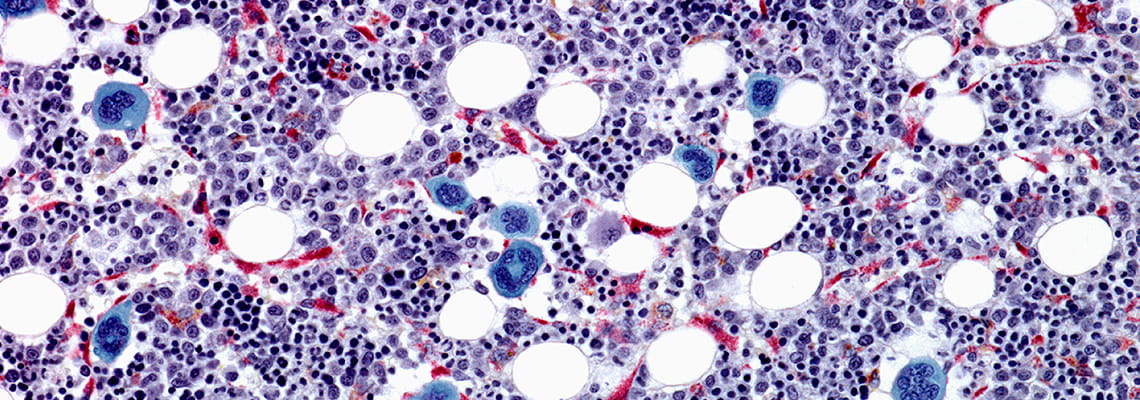 Cancer: Cell & Gene Therapy - Bone Marrow & Stem Cell Transplants ...